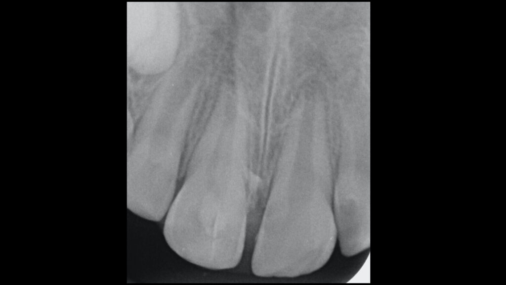 Adhesión del fragmento en una fractura corono-radicular complicada ...