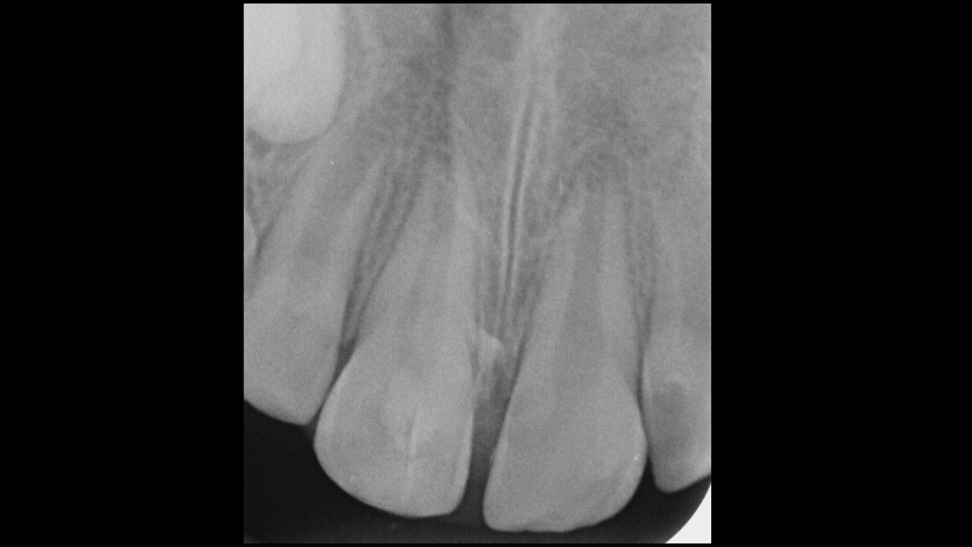 Adhesión del fragmento en una fractura corono-radicular complicada ...