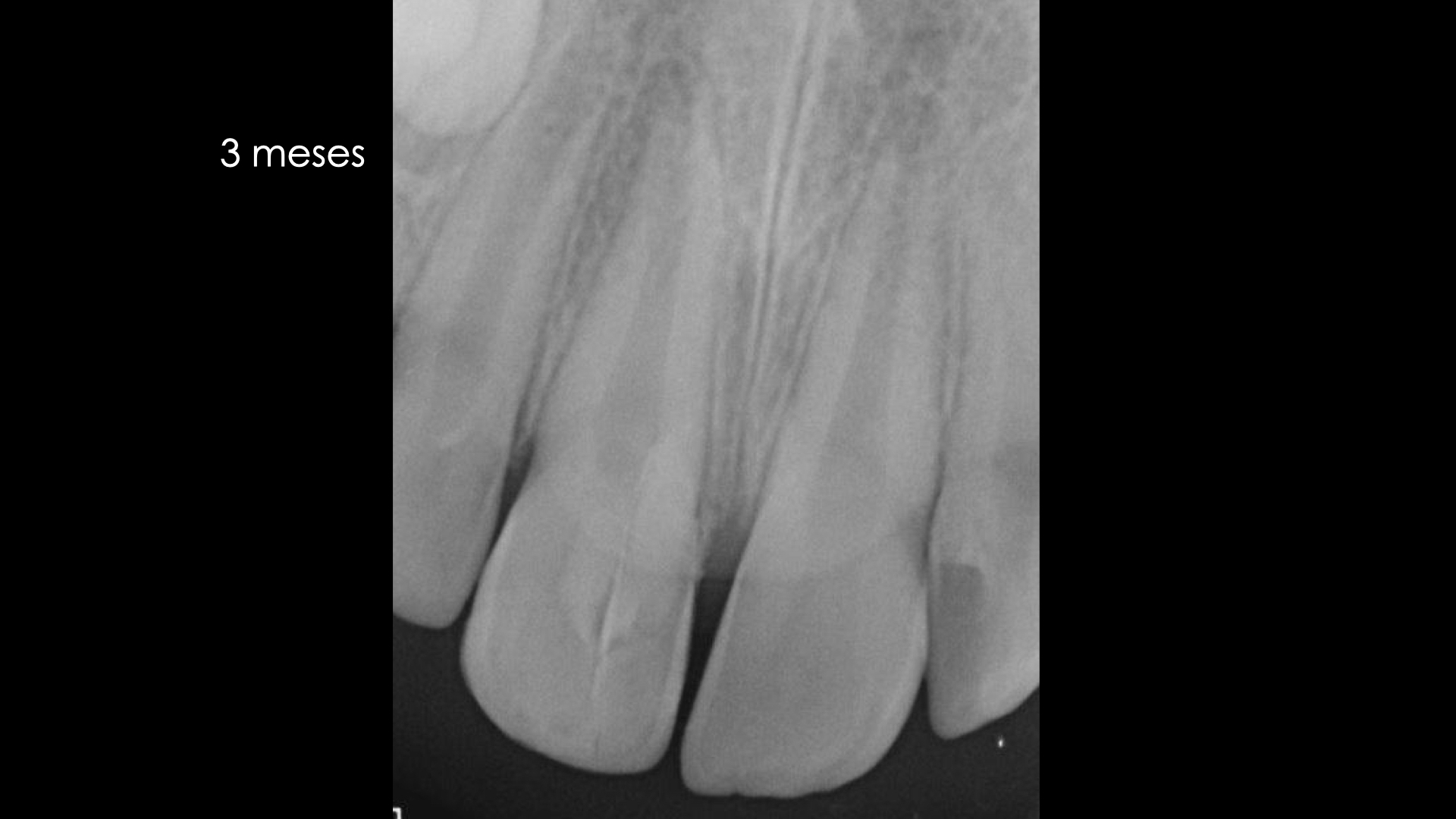 Adhesión del fragmento en una fractura corono-radicular complicada ...