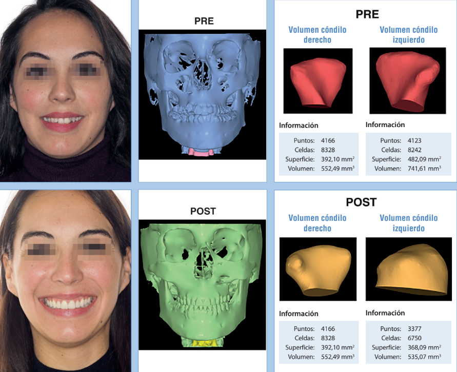 Manejo interdisciplinar con flujo digital de una asimetría esquelética ...