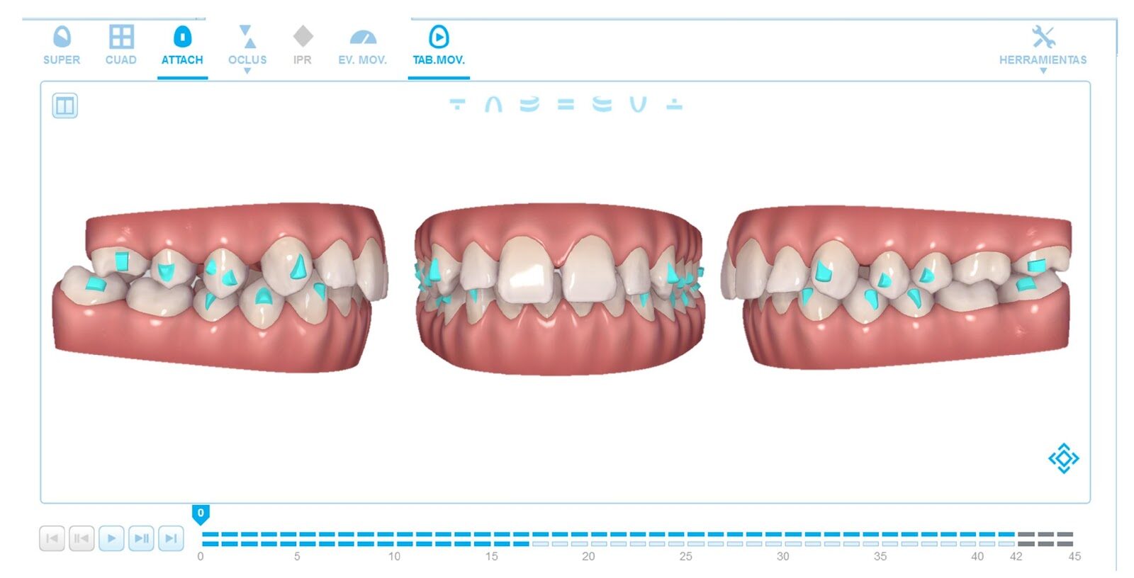 Alineadores Transparentes Mesialización Del Molar Superior Con El Uso