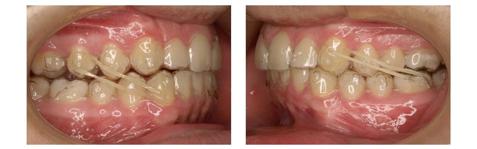 Alineadores transparentes: Mesialización del molar superior con el uso ...