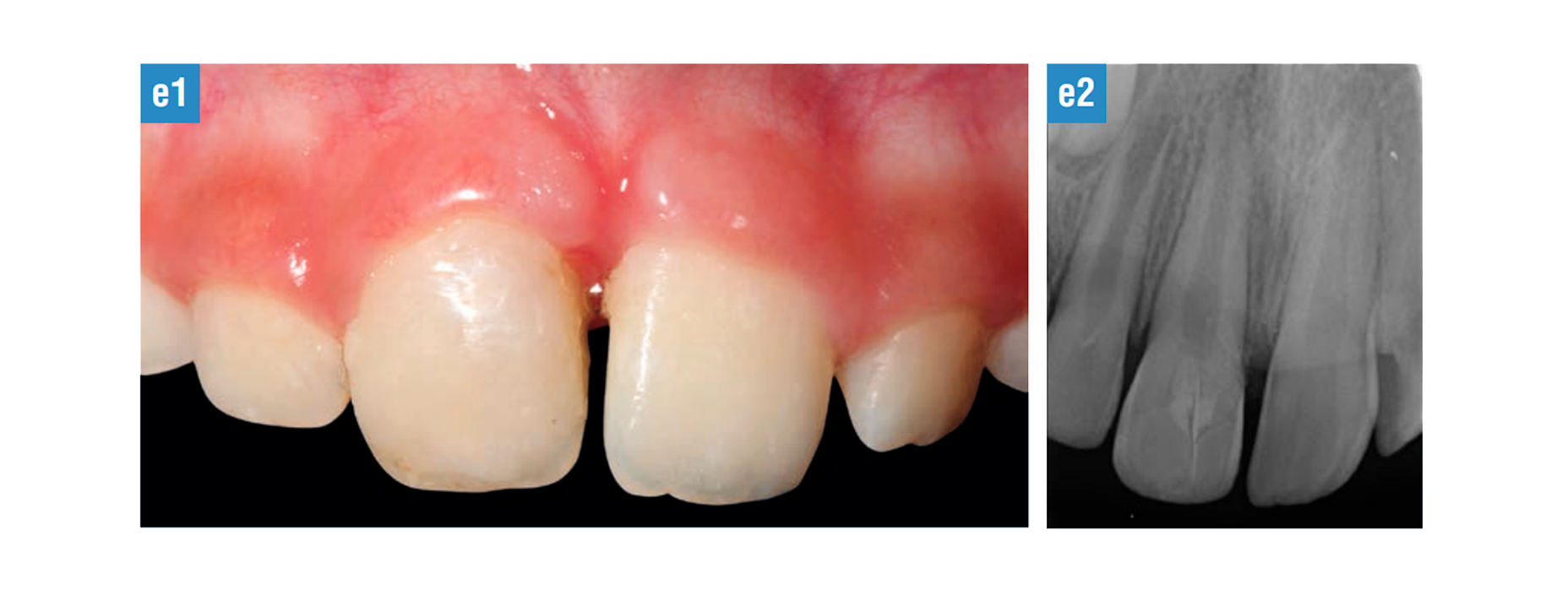 Fracturas corono-radiculares en niños y adolescentes - Instituto IDEOD