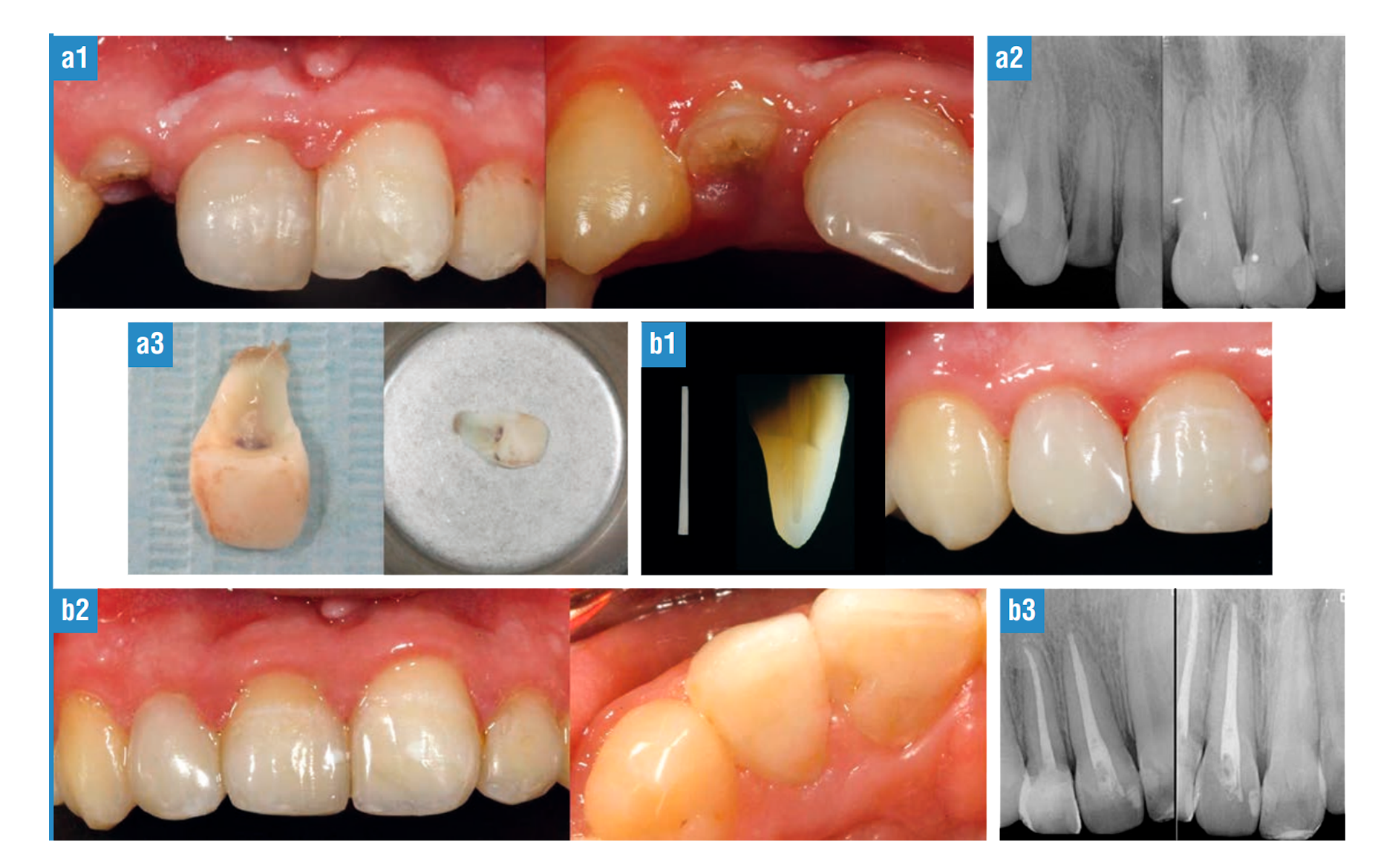 Fracturas corono-radiculares en niños y adolescentes - Instituto IDEOD