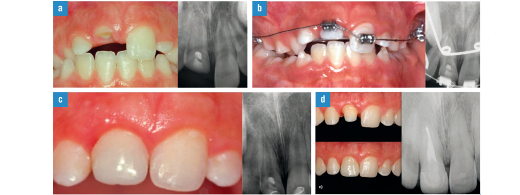 Fracturas corono-radiculares en niños y adolescentes - Instituto IDEOD
